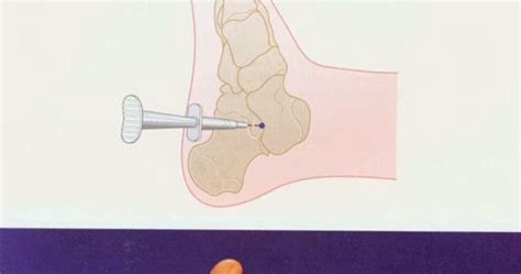 Subtalar Joint Injection Nursing