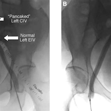 Intravascular Ultrasound Images A Normal Appearance Of The External