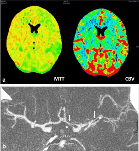 A Ct Perfusion Ctp Presenting Mismatch Between Mean Transit Time Download Scientific Diagram