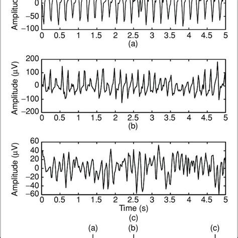 Sotalol Intervention Trends Of The Features A Signal Structure B