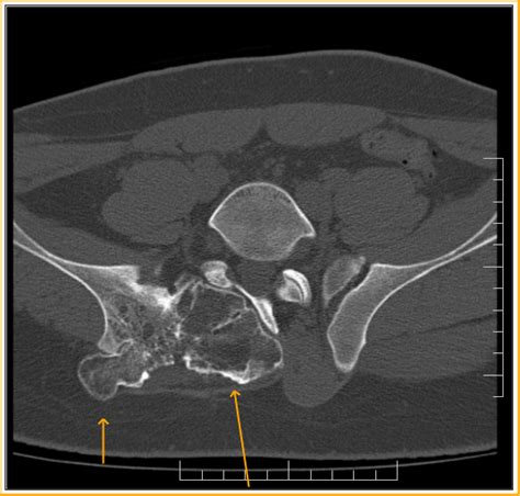 Sacral Osteochondroma Ct Sumers Radiology Blog