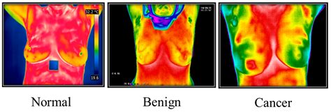 A Review Of Machine Learning Techniques For The Classification And Detection Of Breast Cancer