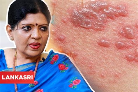 பண உறபபல ஏறபடம Rashes கக எனன தரவ மரததவர கறம வளககம இத லஙகசற நயஸ