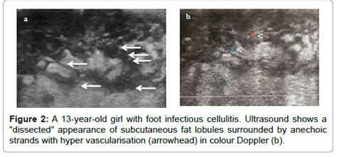 Ultrasound Of Soft Tissue Infections