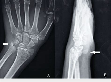 Figure 1 From Atraumatic Isolated Dislocation Of Pisiform With Ulnar