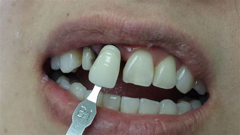 Case 1 Porcelain Crowns Ivory Dental
