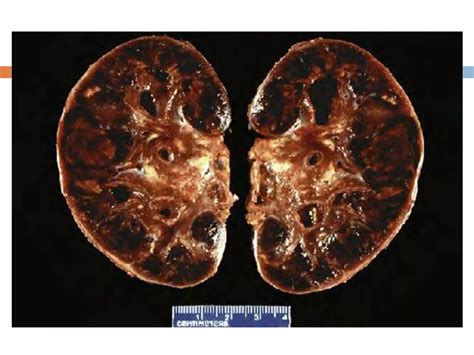 Hyperacute Rejection Of Renal Transplants Pptx