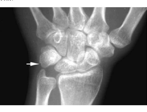 Pisiform Fracture Symptoms