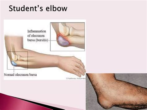 Elbow Joint Ppt