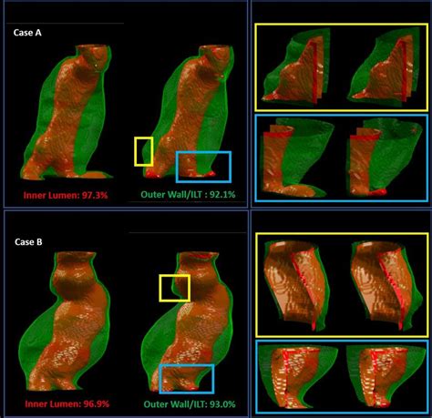 attention based 3d u net outputs for two patients a c with the