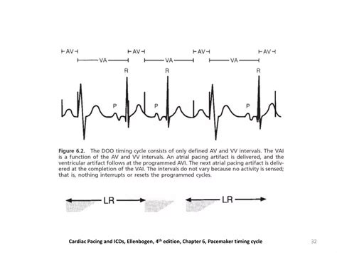 Evaluation And Management Of Pacemaker Malfunction Pptx