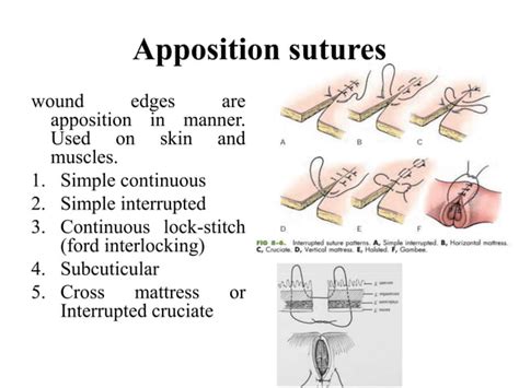Sutures Sutures Materials And Suturing Patterns Ppt