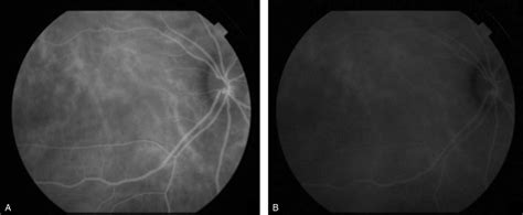 Indocyanine Green Angiography Of The Right Eye Performed At The Initial