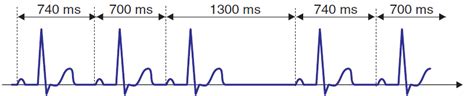 Second Degree Sa Block Type I Wenckebach Ecg