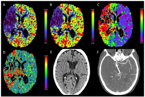 stroke ct scan