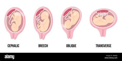 Uterus Position During Pregnancy Fetal Positions Nursingnclex