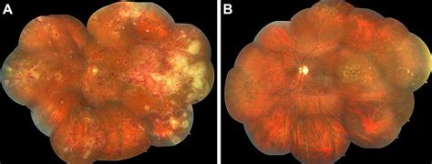 Leukemic Retinopathy Before And After Chemotherapy A 47 Year Old Woman… Rao Musaddaq Ali