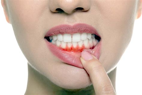 What Are The Benefits Of Gum Contouring Is It Safe Eands Orthodontics