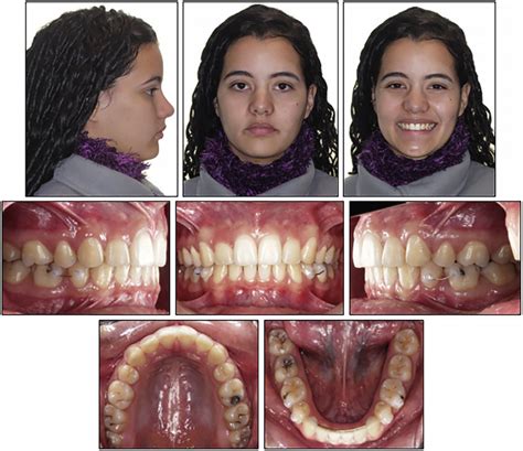Nonsurgical Treatment Of Skeletal Maxillary Protrusion With Gummy Smile Using Headgear For