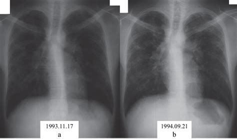 Chest X Ray Films A Nov 17 1993 Bilateral Lymphadenopathy With