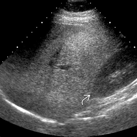 Biloma Radiology Key