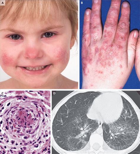 Clinical Features Of Stimulator Of Interferon Genes Sting Associated