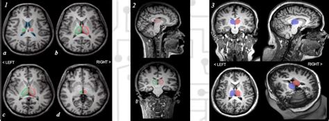 1 Axial Delimitation Of Bilateral Thalamus A Initial Layer