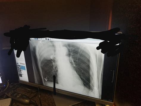 Not Your Standard Syncope Call R Ems