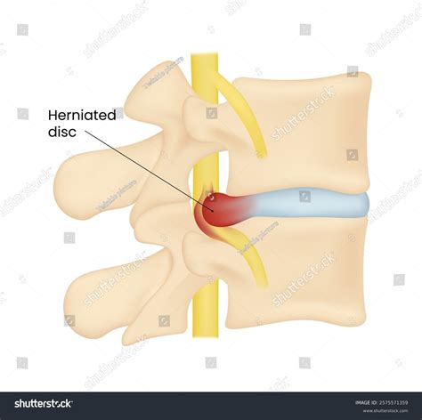 Disc Herniation Symptoms Causes Stock Vector Royalty Free 2575571359
