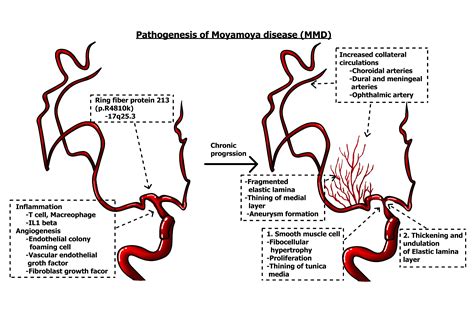 All You Need To Know About Moyamoya Disease Ibs Hospital