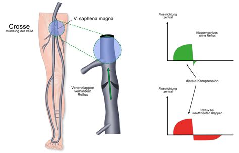Varikosis Vena Saphena Magna Alexander Simpson