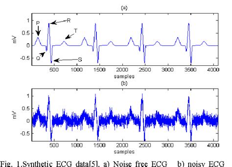 Figure 1 From Ecg Denoising Using Modulus Maxima Of Wavelet Transform