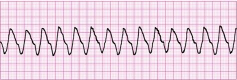 Lethal Ekg Rhythms Flashcards Quizlet