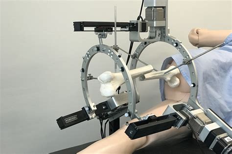 Nsf Supports First Surgical Robot To Align Broken Femurs Joint Health Sciences Center