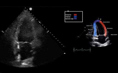 Advanced Echo Pocket Card Series Regional Wall Motion Abnormality Em Ultrasound Section