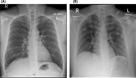 A Before Intubation And B After Intubation Download Scientific Diagram