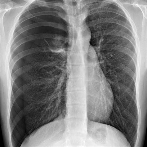 Siim Acr Pneumothorax Segmentation Zip Dataset Kaggle