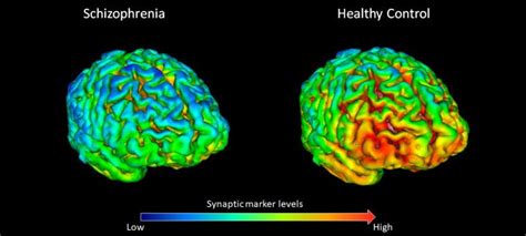 Schizophrenia Brain Vs Normal Brain Schizophrenia Brain Vs Normal Brain