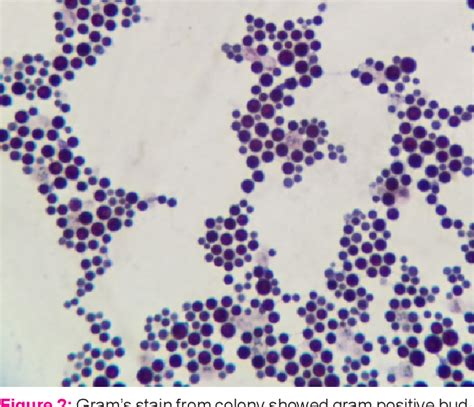 Figure 2 From Isolation Of Cryptococcus Neoformans From Abscess Aspirate In A Pulmonary