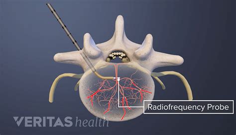 Basivertebral Nerve Ablation Explained Step By Step Spine Health
