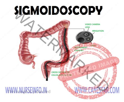 Sigmoidoscopy Nursing Notes Mcqs And Procedures Posttitle