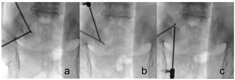 Biportal Endoscopic Radiofrequency Ablation Of The Sacroiliac Joint