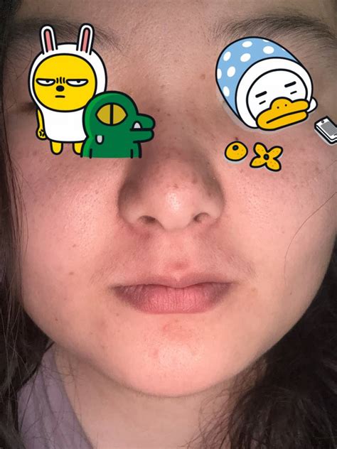 [잡담] 피부더러움ㅎㅇㅈㅇ 인스티즈 Instiz 일상 카테고리