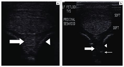 A Transverse Ultrasound Scans Performed At The Level Of The Palmar Download Scientific