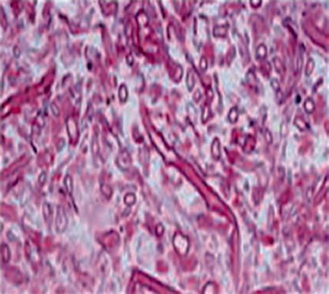 Rhinocerebral Mucormycosis Report Of A Rare Case Pmc