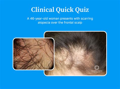 Clinical Quick Quiz What Is The Most Likely Diagnosis For This Scarring Alopecia Over The
