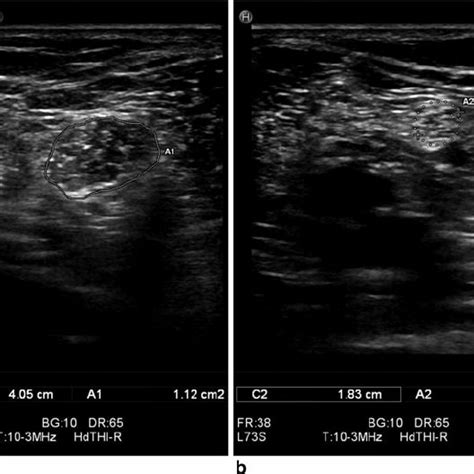 Pdf Ultrasonography Of Multifocal Acquired Demyelinating Sensory And Motor Neuropathy Madsam