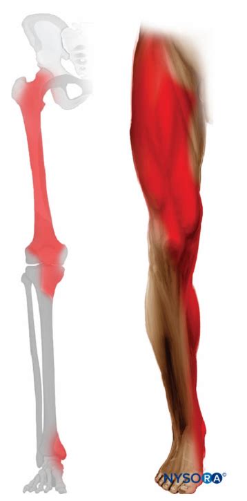 Fascia Iliaca Block Kwak Talk