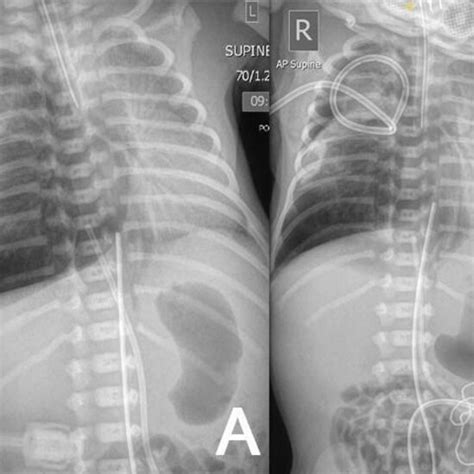 Chest And Abdominal Radiographs Showing Right Sided Pneumothorax First