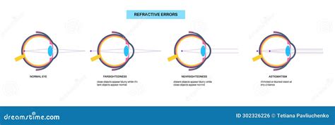 Refractive Errors Poster Stock Vector Illustration Of Hypermetropia 302326226